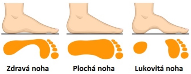 Plochá a kulovitá noha